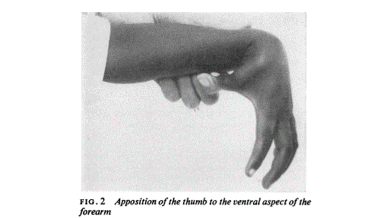Free Online Beighton Score Calculator - OrthoToolKit