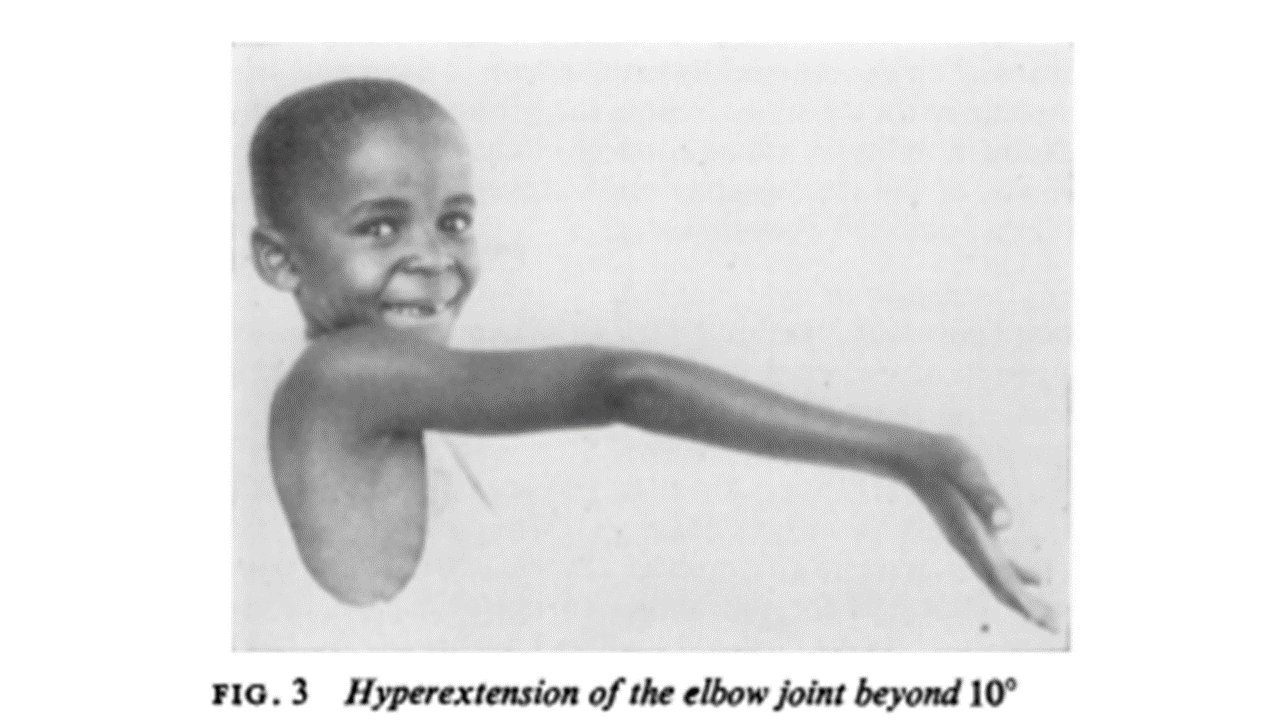 Free Online Beighton Score Calculator - OrthoToolKit