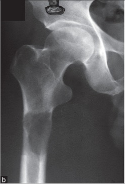 Free Online Mirels Criteria Calculator - OrthoToolKit