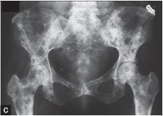 Free Online Mirels Criteria Calculator - OrthoToolKit